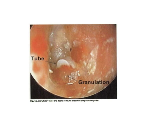 The formation and management of middle ear granulation | PPTX | Ear ...