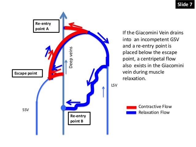 The giacomini vein and its pathological flows ( Phoenix, ACP annual m…