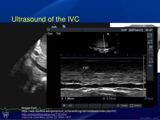 Inferior Vena Cava Guided Fluid Resuscitation