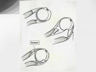 The HAGL lesion | PPT