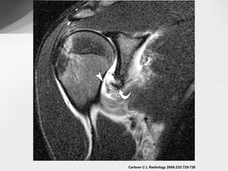 The HAGL lesion | PPT