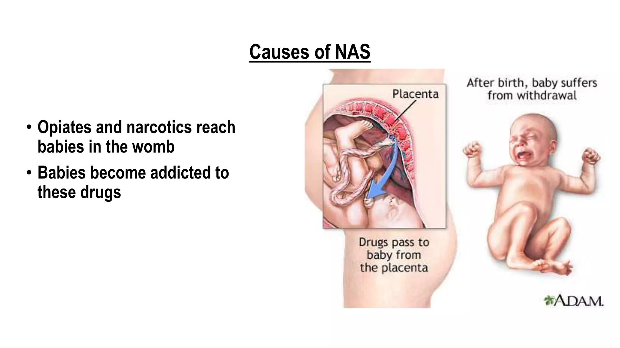 The harrowing effects of heroin on newborns | PPTX
