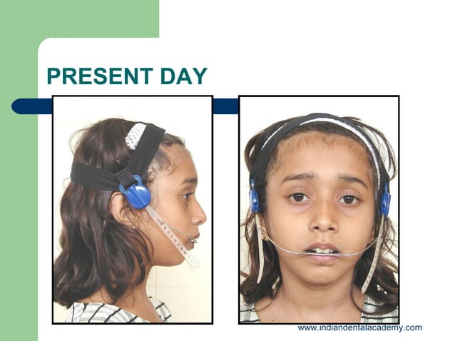 The headgear | PPT | Dental Health | Diseases and Conditions