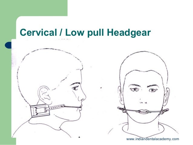 Headgear Orthodontics Slideshare