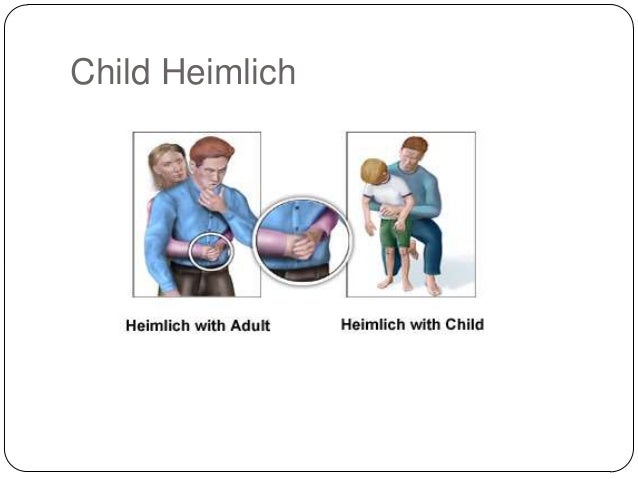 The heimlich maneuver