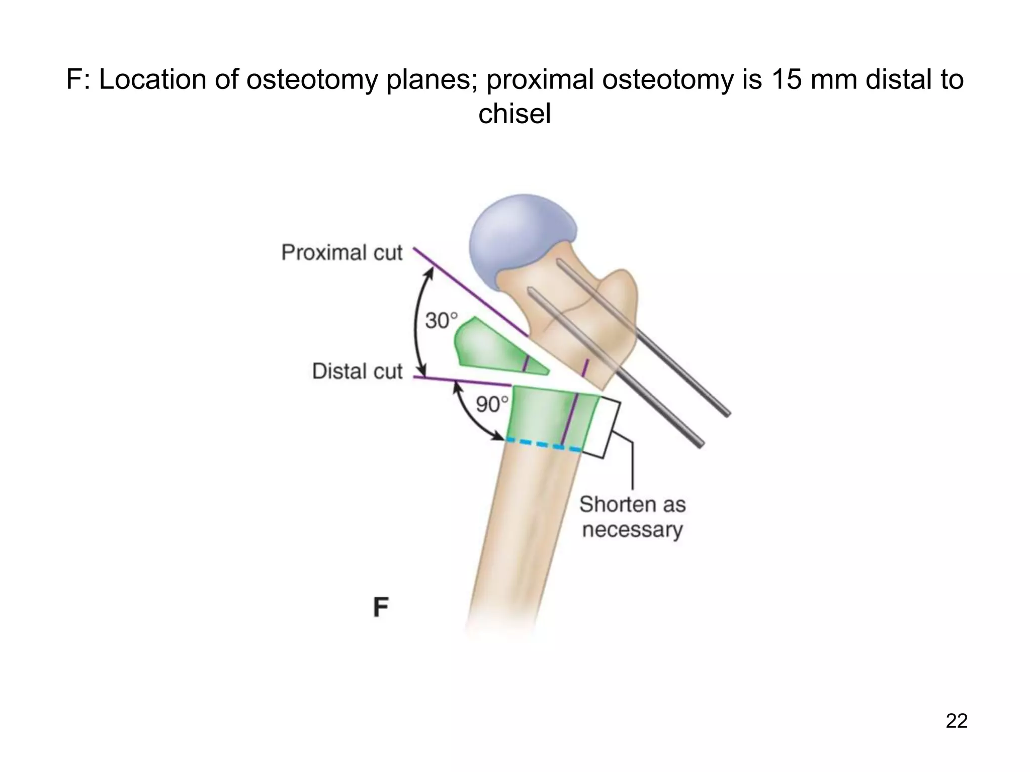 The hip in cerebral palsy part 2 of 2 | PDF