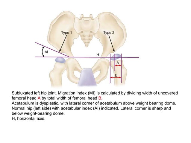 The hip in cerebral palsy part 1 of 2 | PDF