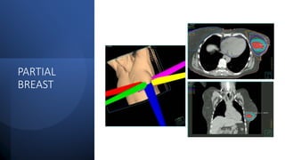 Let's Talk About It: Breast Cancer (The History and Advances in ...