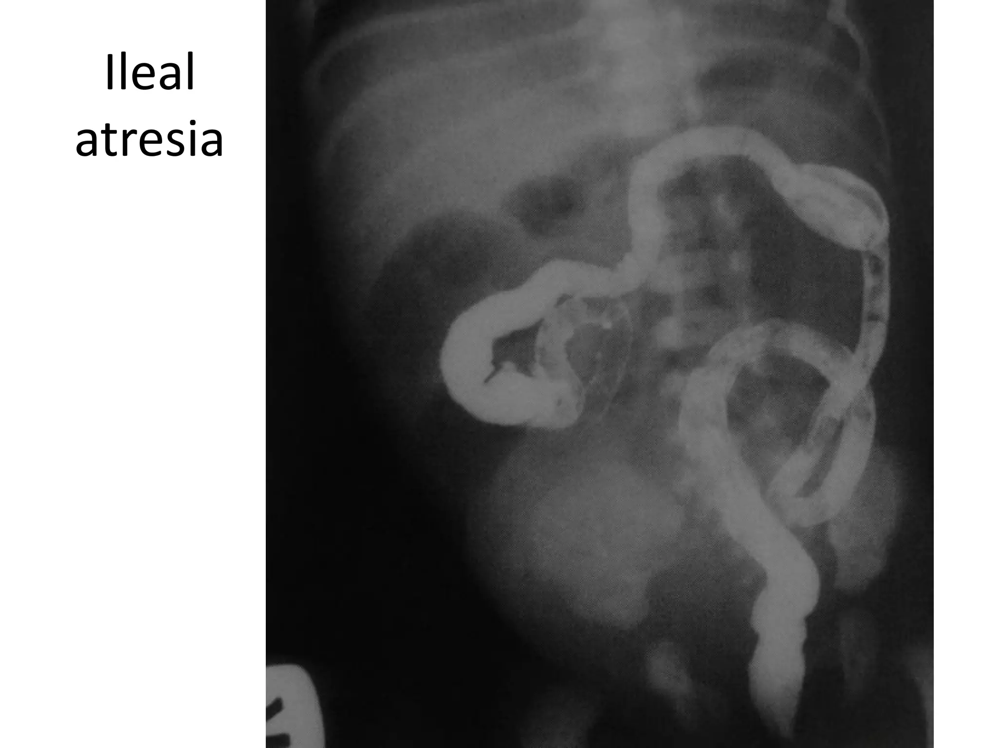 The images of GI tract emergencies in pediatrics | PDF