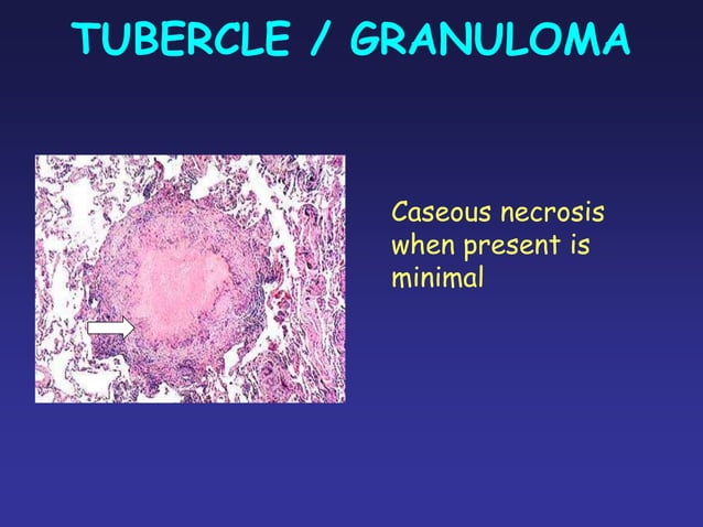 The immunopathology of Tuberculosis | PPT | Lung and Respiratory Health ...