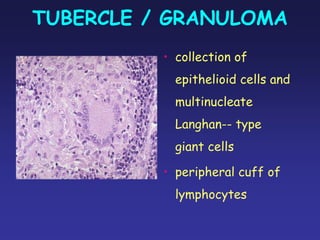 The immunopathology of Tuberculosis | PPT