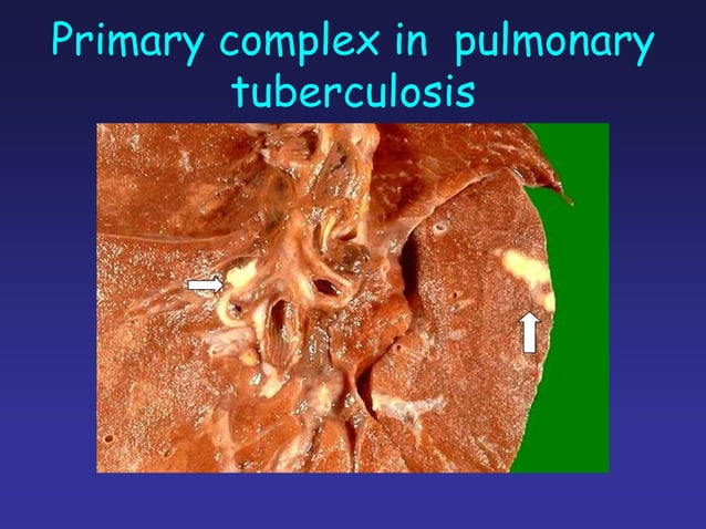 The immunopathology of Tuberculosis | PPT | Lung and Respiratory Health ...