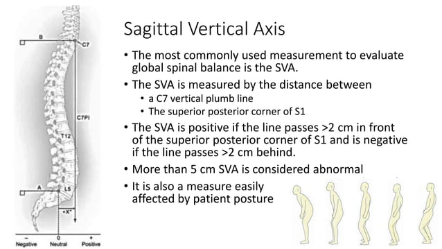 The Importance of Sagittal Balance in Adult Spinal.pptx | Death, Injury ...
