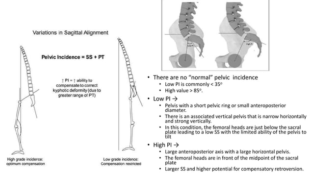 The Importance of Sagittal Balance in Adult Spinal.pptx | Death, Injury ...
