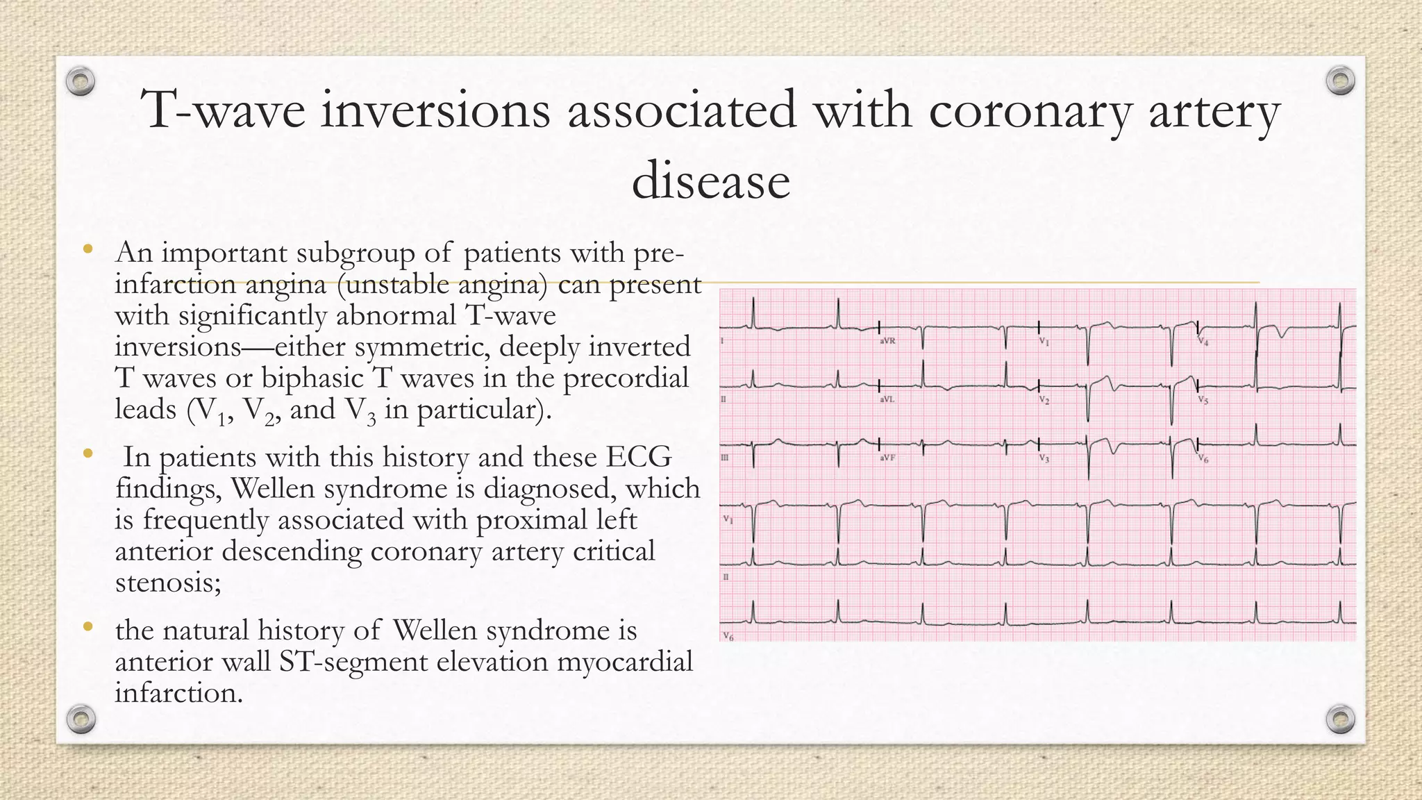 ECG-T wave inversion , Dr. Malala Rajapaksha ,Cardiology unit,General ...