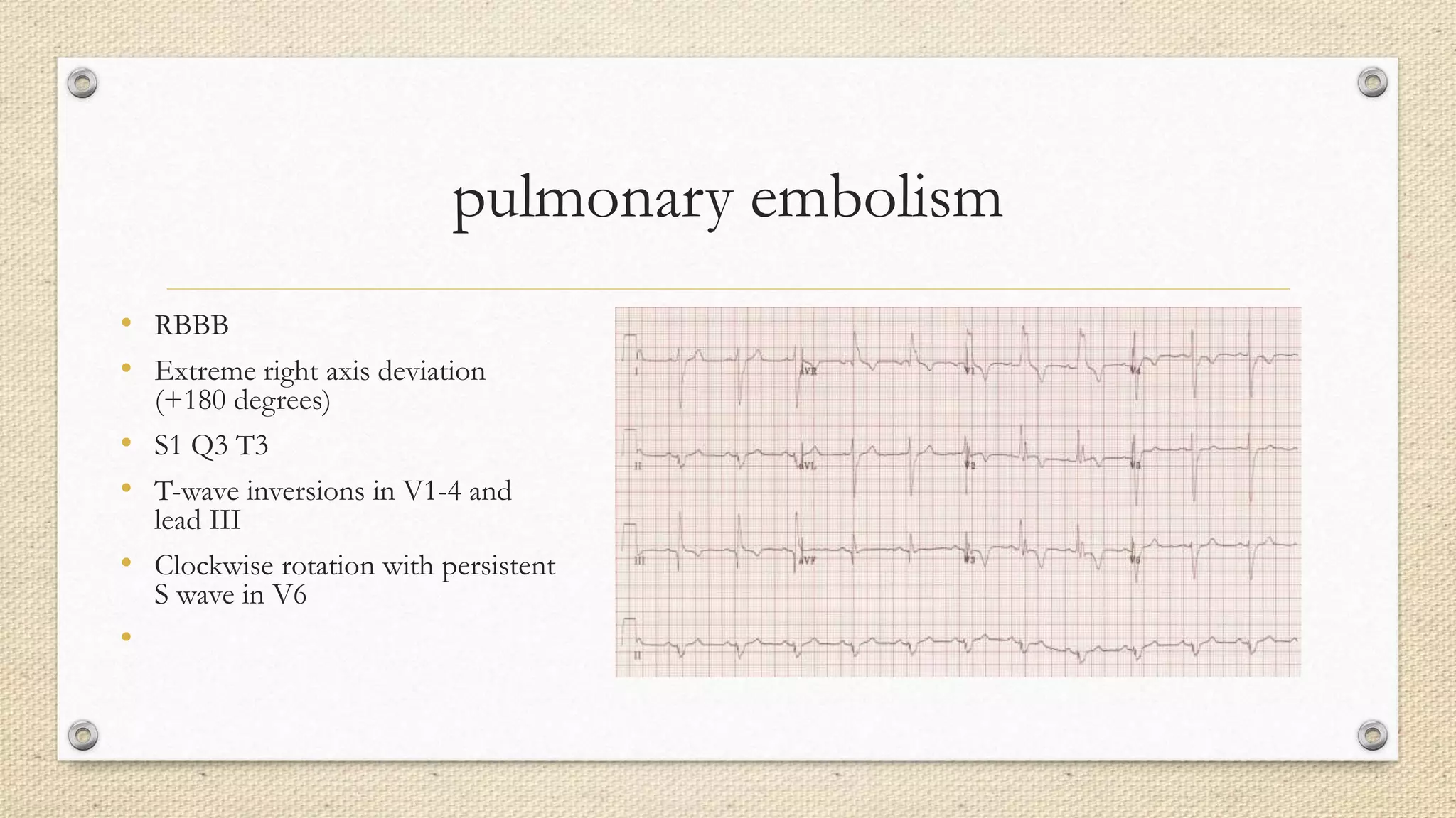 ECG-T wave inversion , Dr. Malala Rajapaksha ,Cardiology unit,General ...