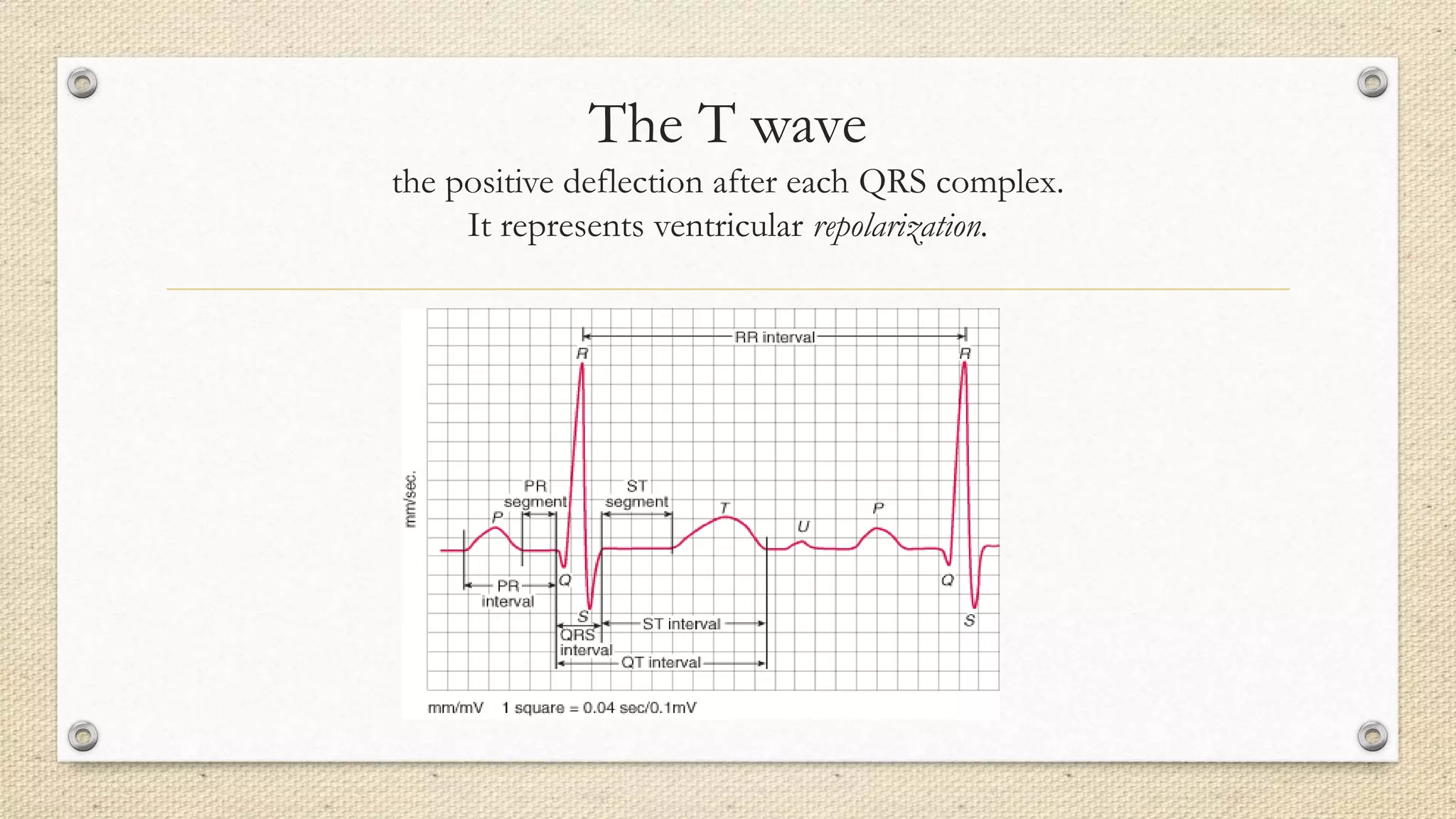 ECG-T wave inversion , Dr. Malala Rajapaksha ,Cardiology unit,General ...