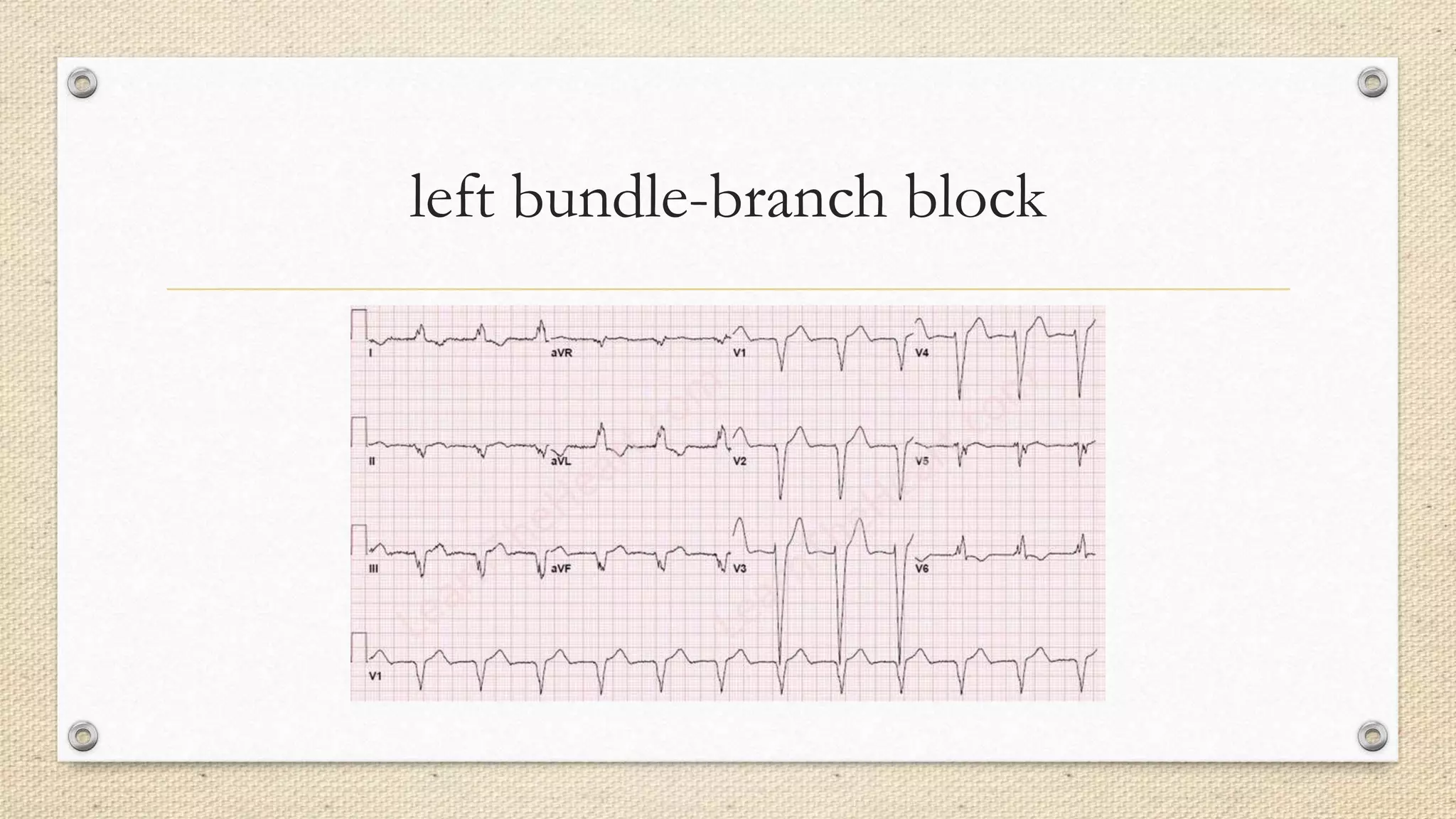 ECG-T wave inversion , Dr. Malala Rajapaksha ,Cardiology unit,General ...