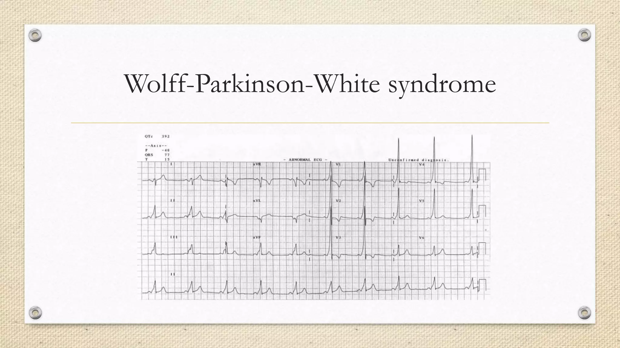 ECG-T wave inversion , Dr. Malala Rajapaksha ,Cardiology unit,General ...