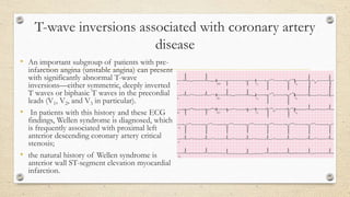 ECG-T wave inversion , Dr. Malala Rajapaksha ,Cardiology unit,General ...