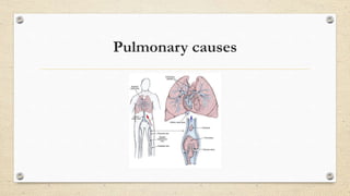 ECG-T wave inversion , Dr. Malala Rajapaksha ,Cardiology unit,General ...