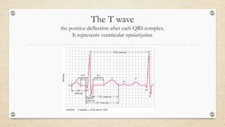 ECG-T wave inversion , Dr. Malala Rajapaksha ,Cardiology unit,General ...