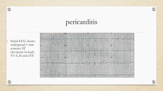 ECG-T wave inversion , Dr. Malala Rajapaksha ,Cardiology unit,General ...