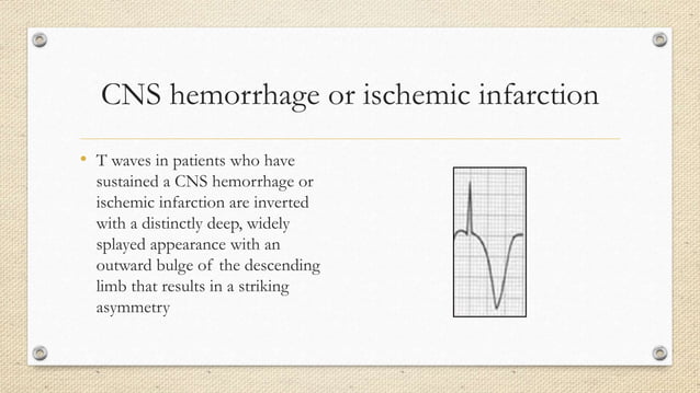 ECG-T wave inversion , Dr. Malala Rajapaksha ,Cardiology unit,General ...