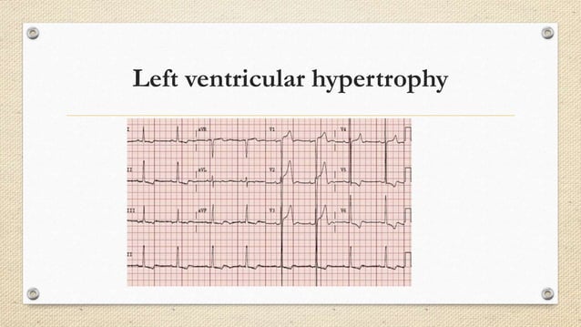 ECG-T wave inversion , Dr. Malala Rajapaksha ,Cardiology unit,General ...