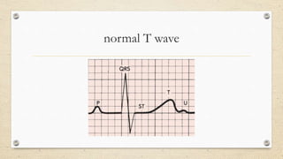 ECG-T wave inversion , Dr. Malala Rajapaksha ,Cardiology unit,General ...