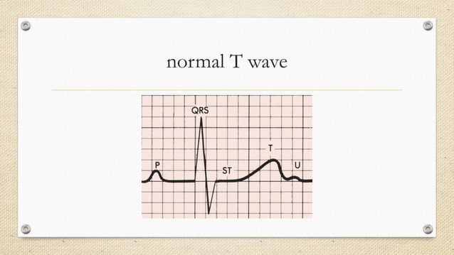 ECG-T wave inversion , Dr. Malala Rajapaksha ,Cardiology unit,General ...