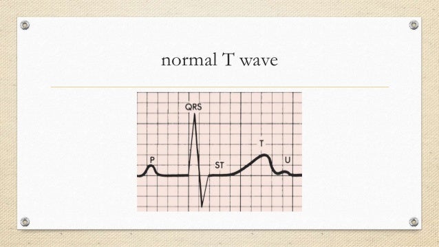ECG-T wave inversion , Dr. Malala Rajapaksha ,Cardiology unit,Genera…