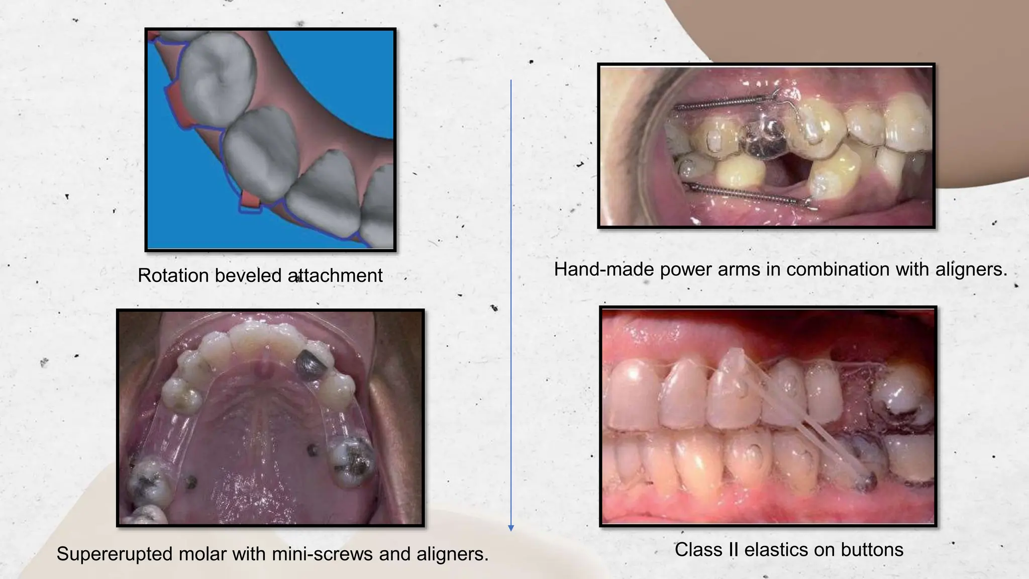 THE INVISALIGN aligner in orthodontics .pptx