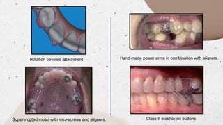 THE INVISALIGN aligner in orthodontics .pptx