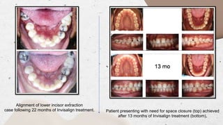THE INVISALIGN aligner in orthodontics .pptx