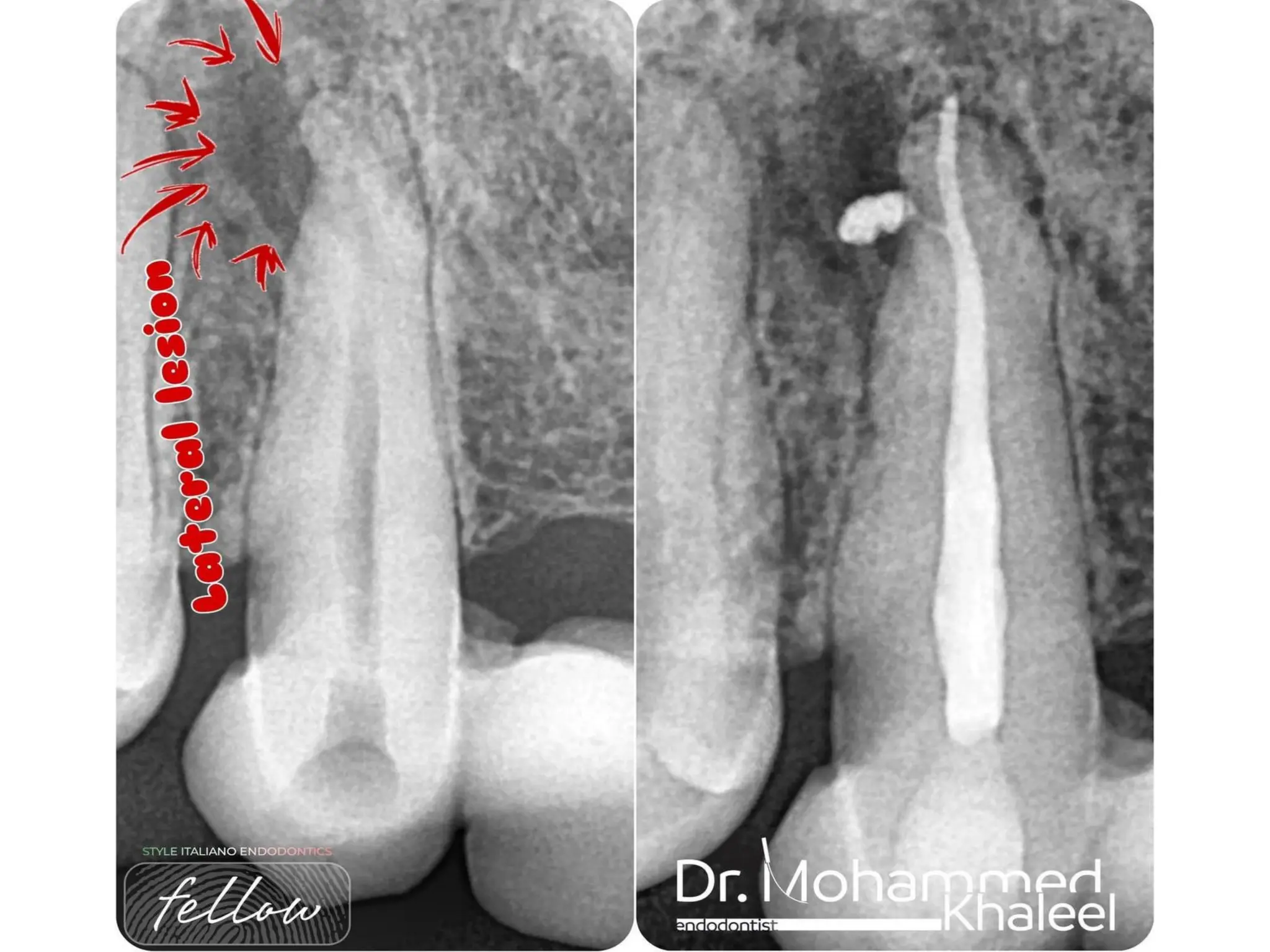 The Journey to Management Of Sinus Tract.pptx