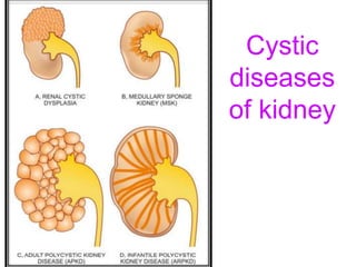 CONGENITAL MALFORMATIONS OF KIDNEY | PPTX
