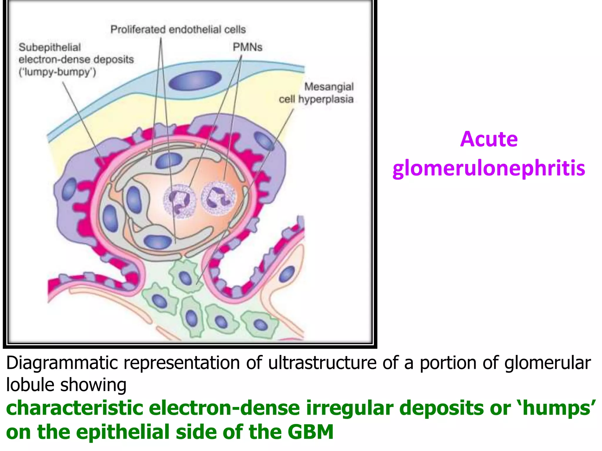 The KIDNEY: SPECIFIC TYPES OF GLOMERULAR DISEASES | PPTX