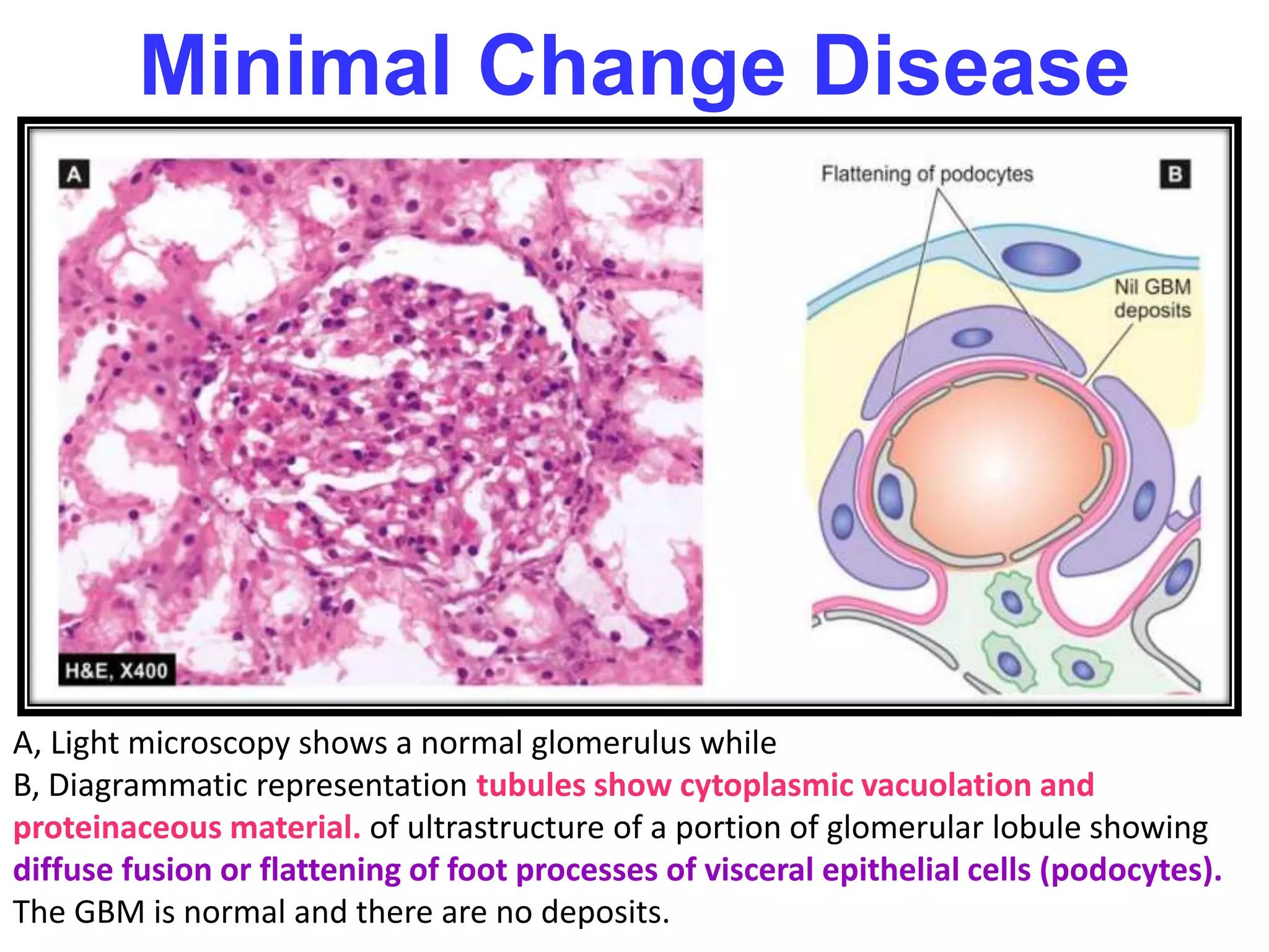 The KIDNEY: SPECIFIC TYPES OF GLOMERULAR DISEASES | PPTX