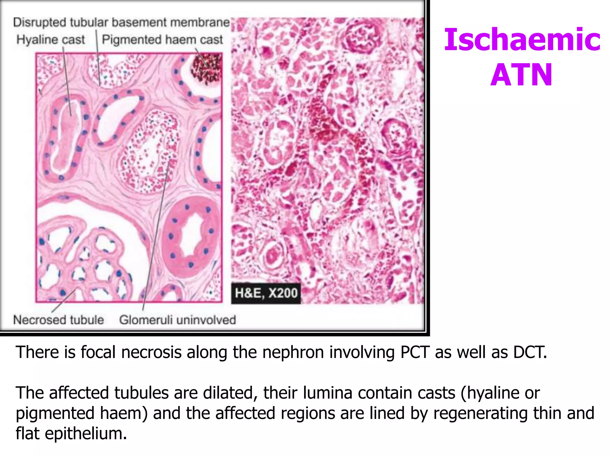 TUBULAR & TUBULOINTERSTITIAL DISEASES | PPTX