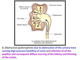 TUBULAR & TUBULOINTERSTITIAL DISEASES | PPTX