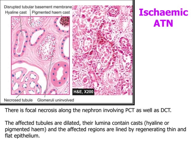 TUBULAR & TUBULOINTERSTITIAL DISEASES | PPTX