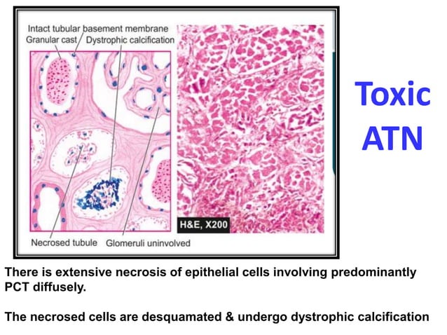 TUBULAR & TUBULOINTERSTITIAL DISEASES | PPTX