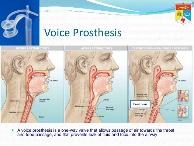 The Laryngectomee guide english