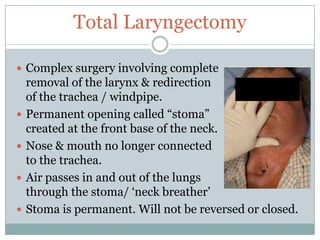 The laryngectomy patient | PPT