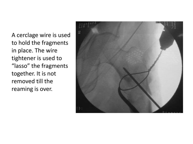 The lasso technique in Intertrochanteric fractures | PPT