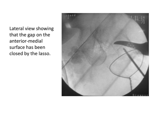 The lasso technique in Intertrochanteric fractures | PPT