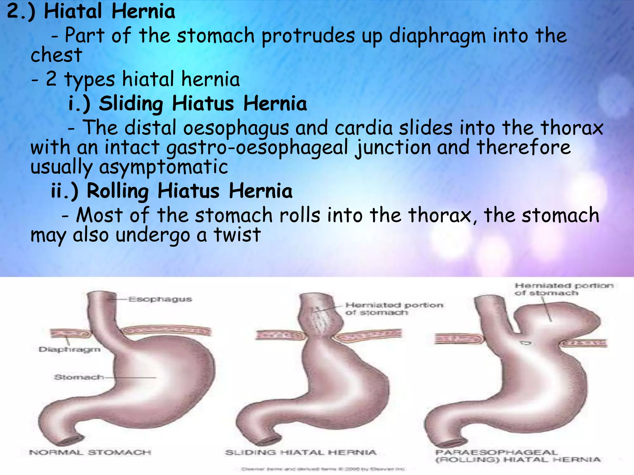 Hernia | PPTX