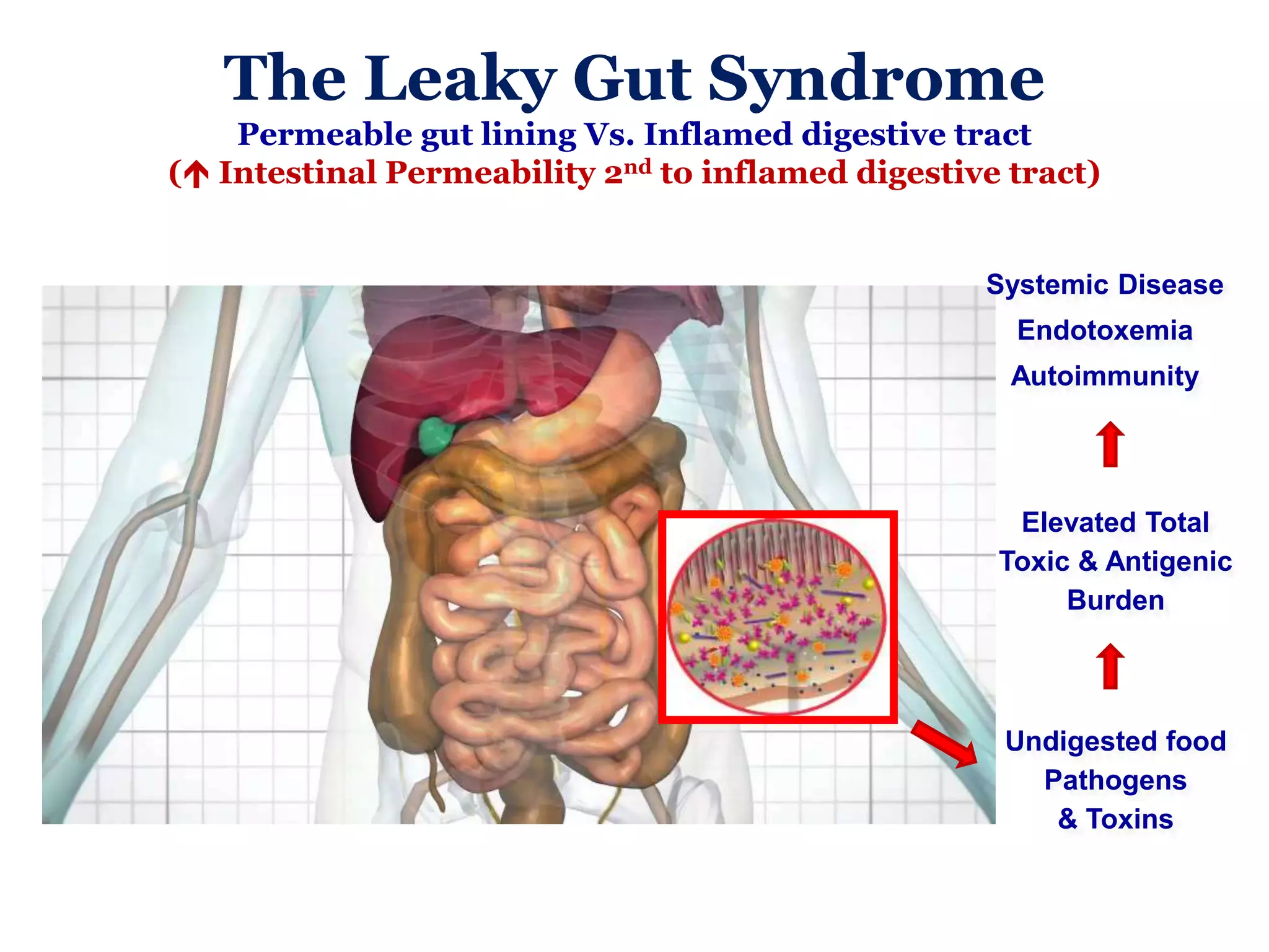 The leaky gut syndrome | PPTX