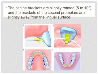 Lingual Liberty System about different orthodontic brackets.pptx